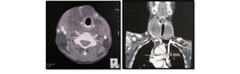 Contrast Enhanced Ct In Axial And Coronal View Showing A Diffuse Goiter Download Scientific Contrast Enhanced Ct In Axial And Coronal View Showing A Diffuse Goiter Download Scientific