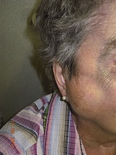 Acute Bacterial Parotitis In The Frail Elderly Subject A Harbinger Of