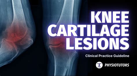 Knee Cartilage Lesion At Ladonna Teal Blog