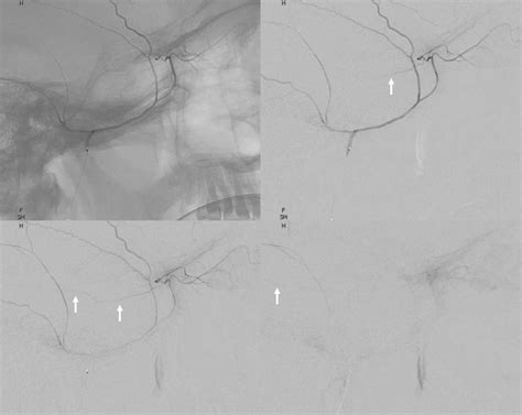 Lacrimal Artery