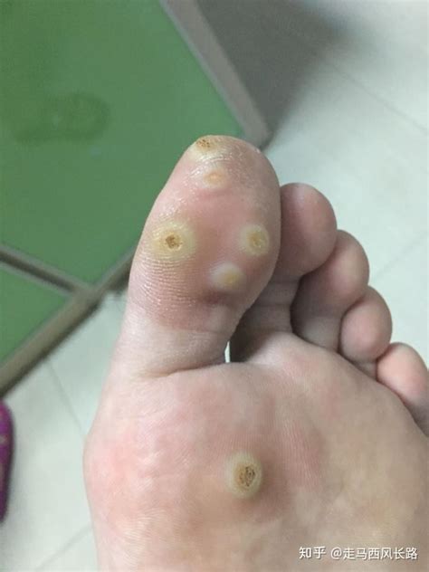 我的跖疣治好了，聊一下我的跖疣治疗之路。 知乎