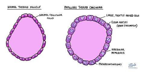Papillary Thyroid Carcinoma Mypathologyreportca