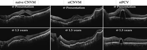 Real World Experience Of Brolucizumab In Namd Indian Journal Of