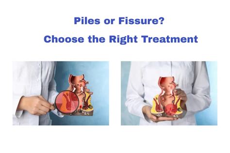 Fissure Vs Fistula Vs Piles Key Differences