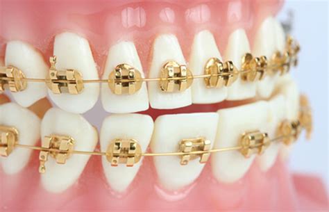 History Of Braces Timeline Timetoast Timelines