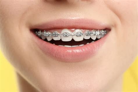 Aligners Or Braces Which Is Better For Correcting Your Bite