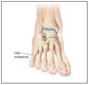 Base Of 5th Metatarsal Fracture University Hospitals Sussex Nhs