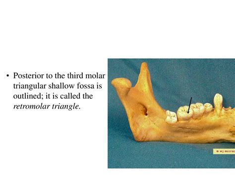 Retromolar Triangle