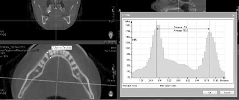 Definition Of Bone Density Between 33 And 34 Teeth Download Scientific Diagram