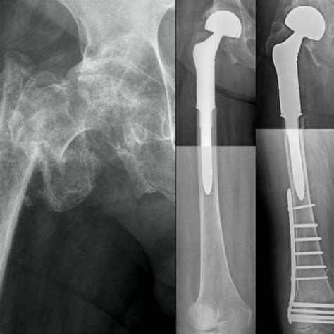 Judet Letournel Classification Of Acetabular Fractures Into Five