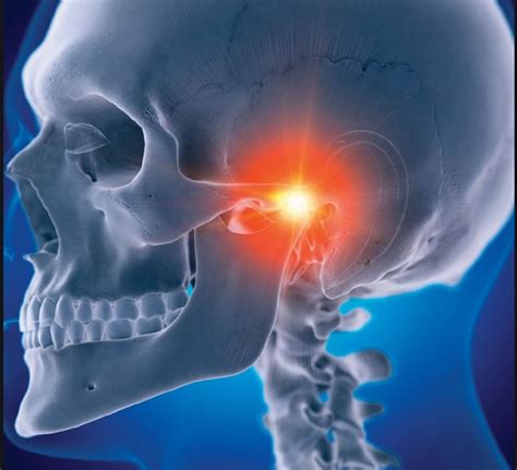 Prek Nyjet E Nofullës Sindroma Costen Shkaqet Simptomat Dhe Trajtimi