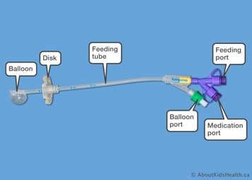 Feeding Tube Parts Polymed Gastro Duodenal Gastrostomy Feeding Tube