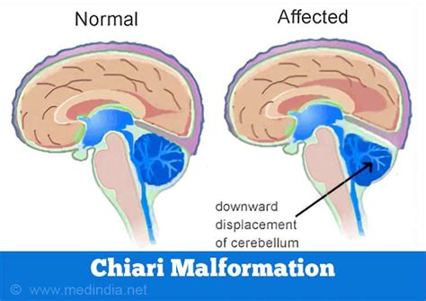 Chiari Malformation Arnold Chiari Malformation Types Symptoms