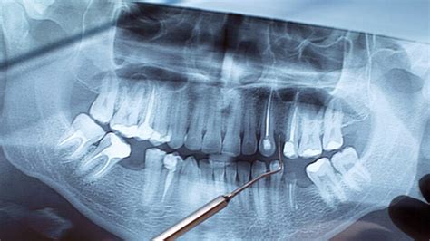 Apicoectomy Surgery Procedure Benefits And Recovery