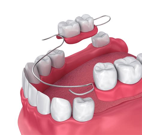Proteza Scheletata Proteze Partiale De Calitate Superioara