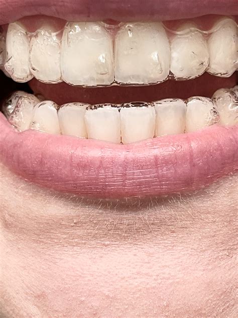 Aligners Tracking Rinvisalign