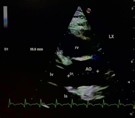 Measurement Of Aortic Diameter Obtained At 3 Cm Above The Aortic Cusps