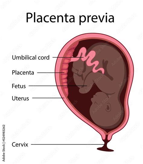 Placental Previa Fetus In Uterus During Pregnancy Pregnancy Women Anatomy Fetus With