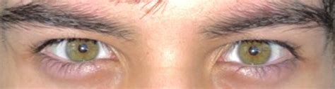 How Can I Achieve The Hunter Eye Look Without Surgery