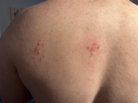 2 Incredibly Itchy Spots On My Back Rdermatologyquestions