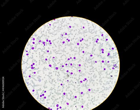 Blood Smear Under Microscopy Showing Chronic Lymphoblastic Leukemia