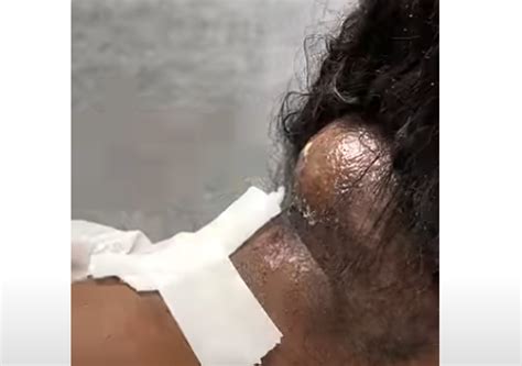 Massive Occipital Scalp Abscess New Pimple Popping Videos