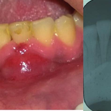 Periodontal Abscess And Periapical Abscess Download Scientific Diagram