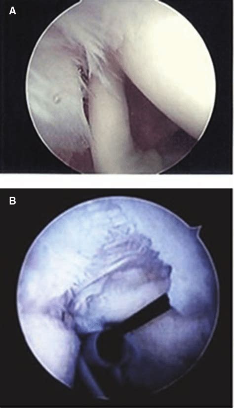 Partial Thickness Rotator Cuff Tear Ranging From 10 A To 40 B Download Scientific Diagram