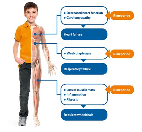 Duchenne Muscular Dystrophy Illustrations Creative Med 55 Off