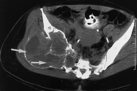 Diagnosis Of Primary Bone Tumors With Image Guided Percutaneous Biopsy