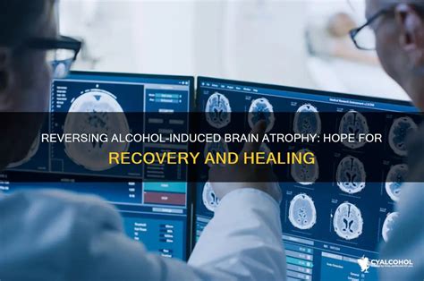 Reversing Alcohol Induced Brain Atrophy Hope For Recovery And Healing