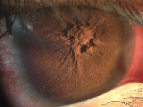 Persistent Pupillary Membrane Eyeducation