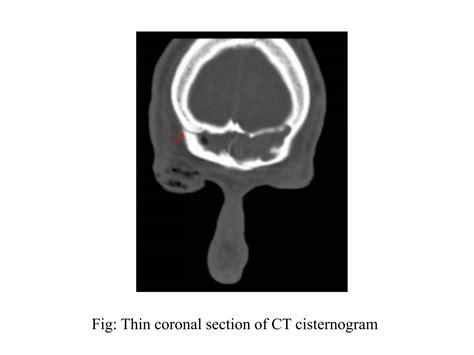 Cisternography Sujan Pptx