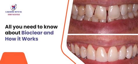 Celebrities Teeth Before After A Closer Look