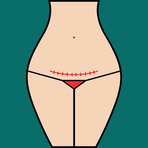 Bleeding After C Section Stopped And Then Started Again Bright Red