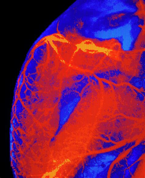 Fcol Coronary Angiogram Stenosed Artery By Science Photo Library