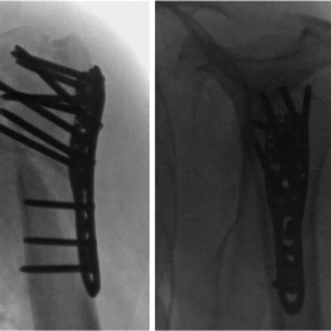 Intraoperative Radiographs Of Open Reduction And Internal Fixation Download Scientific Diagram