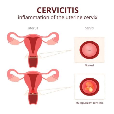 Yellow Discharge Causes Types Anatomy Images