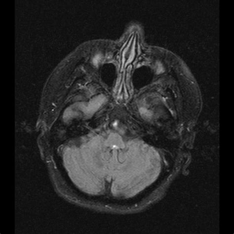 Fazekas Scale Stroke Manual