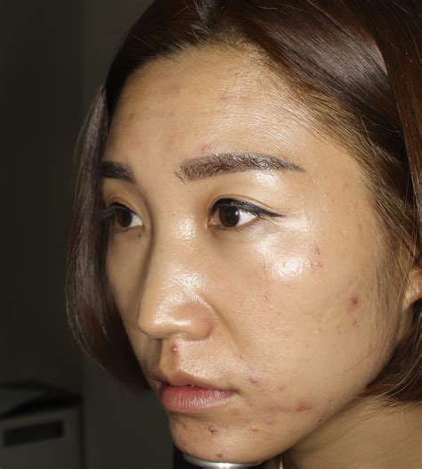 Fnl Classification Model By Acne