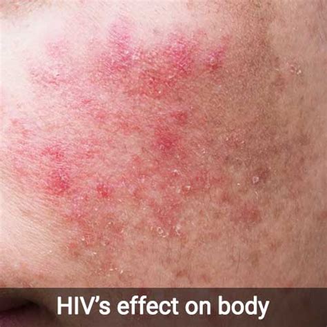 Hiv Symptoms In Women Rash