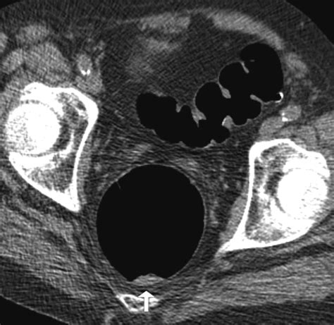 Ct Colonography After Fecal Tagging With A Reduced Cathartic Cleansing