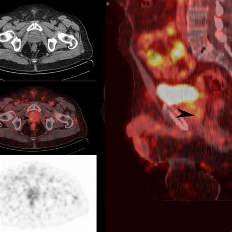 A 80 Year Old Patient Status Post Radical Prostatectomy Psa Level At