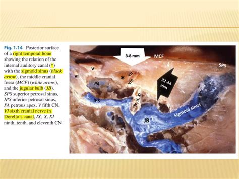 Temporal Bone And Mastoid Anatomy Arjun Antony Graison Pptx