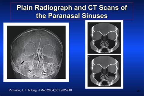Cap Sinusitis Pharyngitis Im0306ppt