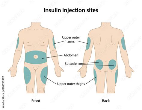 Diabetes Insulin Injection Sites Shown On The Body Upper Outer Arms Abdomen Buttocks Upper