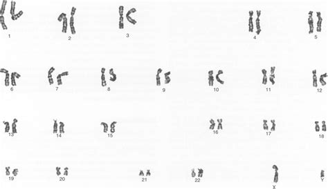 A Karyotype Of A Non Clonal Abnormal Metaphase From Case 3