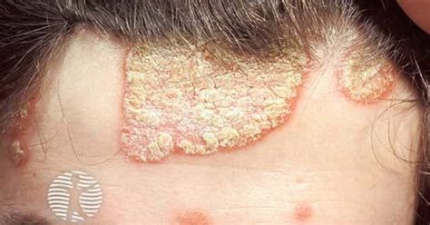 What Is Plaque Psoriasis On Your Scalp