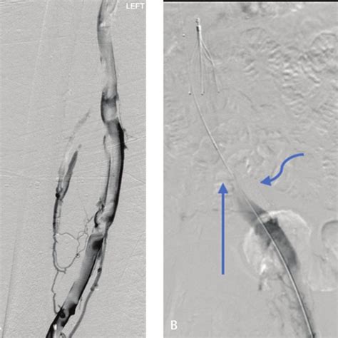 Acute Dvt Involving The Left Civ Eiv Common Femoral Vein Cfv And
