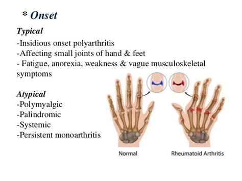 Polyarthritis Clinical Approach